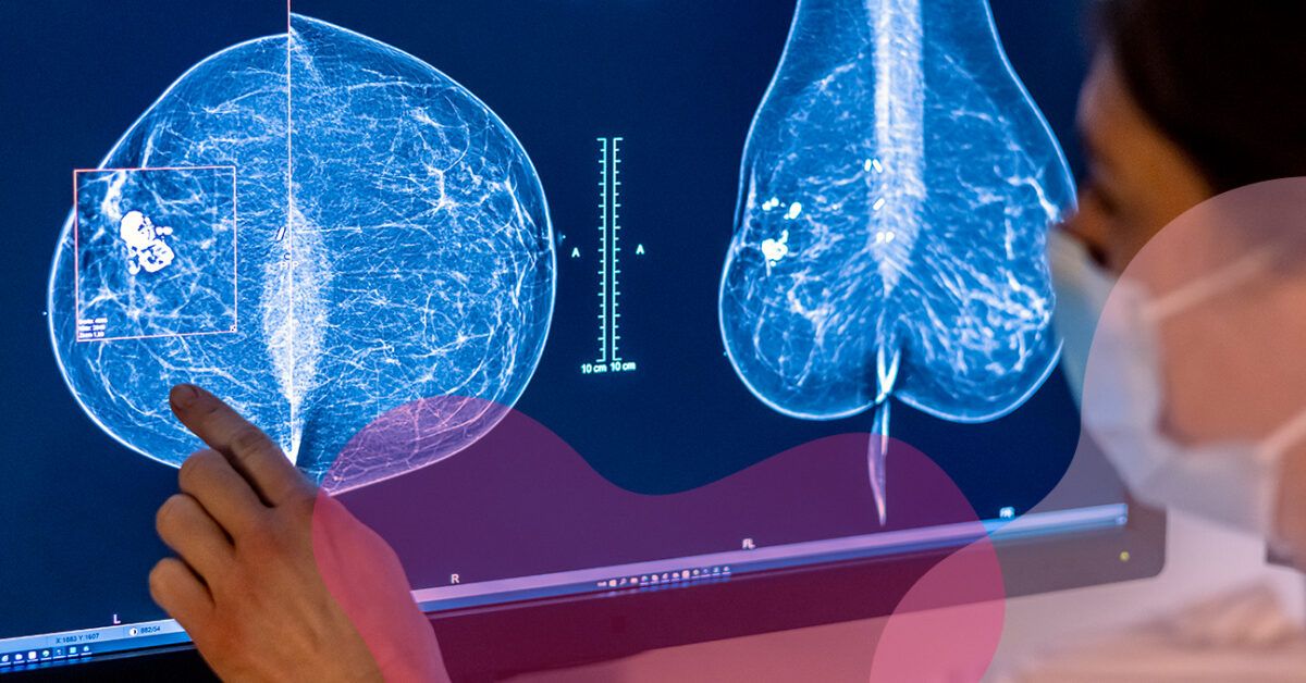 Screening vs. Diagnostic Mammogram: Purpose, Protocol, and Results