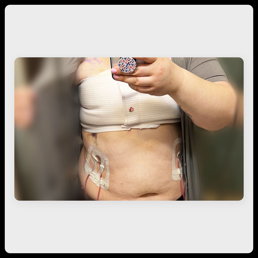 What It Looks Like: Double Mastectomy with Latissimus Dorsi Flap