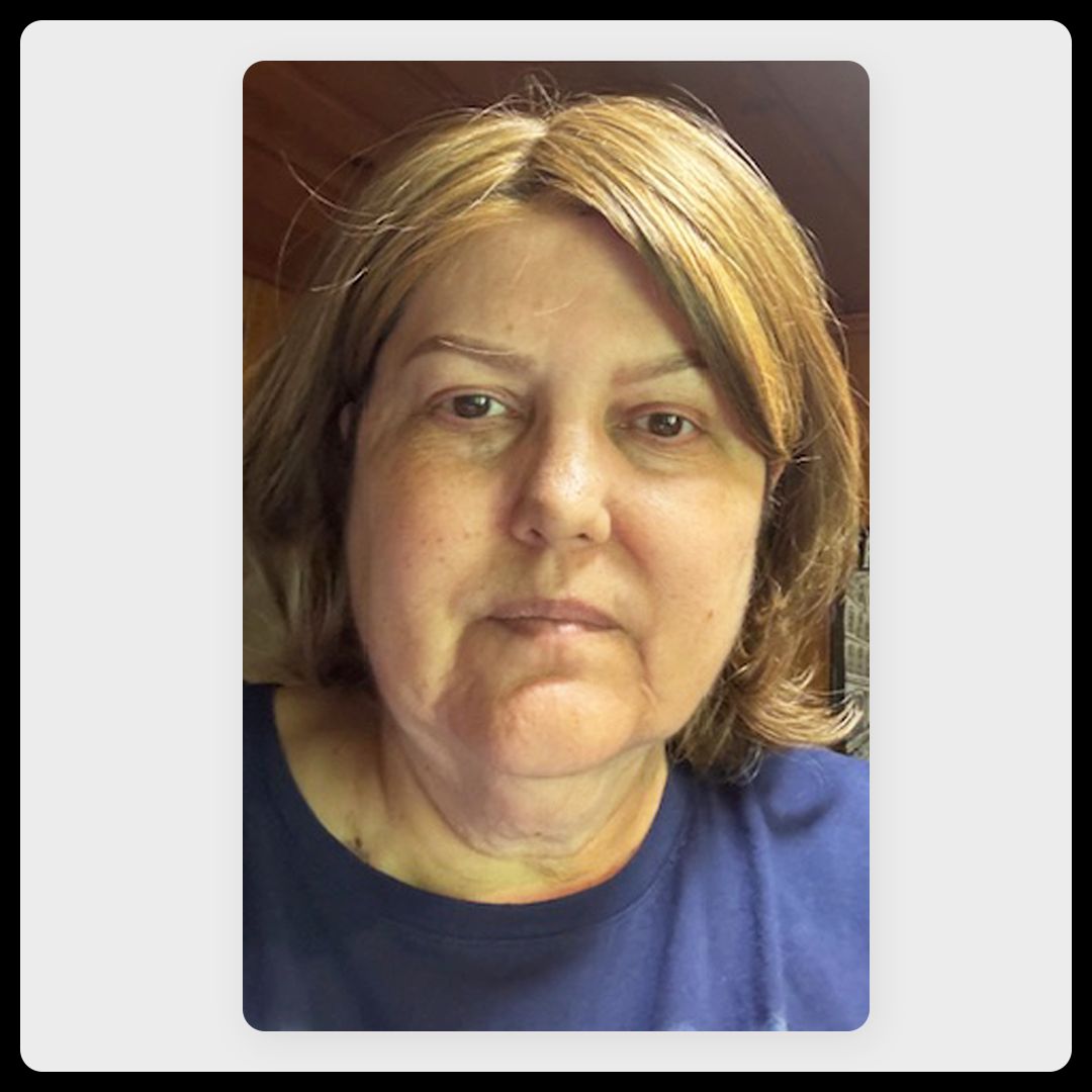 Eyebrow Microblading After Chemo for Breast Cancer