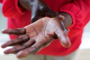 What You Need To Know About Stage 1 Early Rheumatoid Arthritis In Hand What You Need To Know About Stage 1 Early Rheumatoid Arthritis In Hand