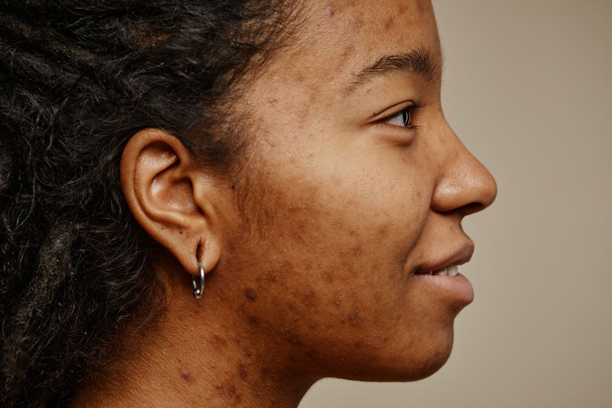 Accutane side effects: 7 side effects you need to know about | Optum Perks